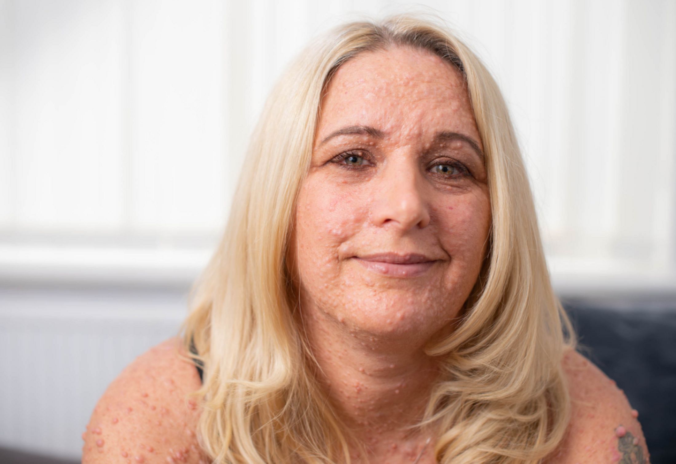 My ‘bubble’ skin won’t stop me! | that's life!