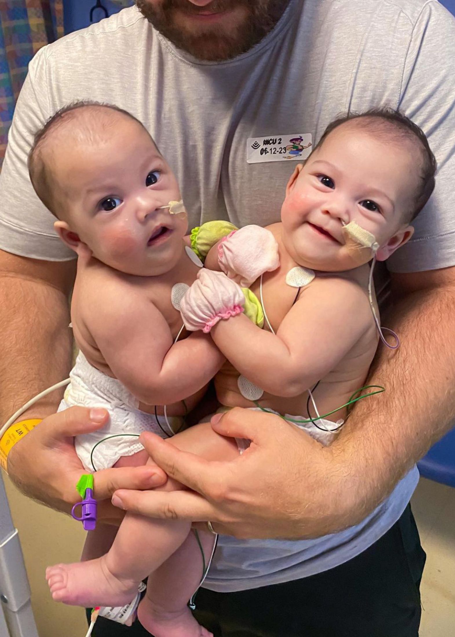 My Sweet Girls Were Born Conjoined - Mum Sandy Fuller explains how her ...