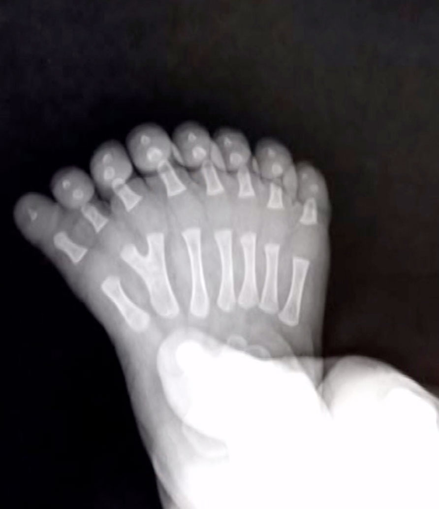Incredible surgery to help baby born with 16 fingers and 15 toes | that ...