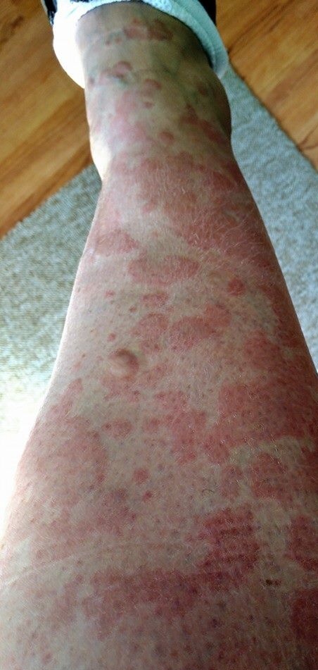 Allergic to diet foods - the astonishing condition that landed this ...